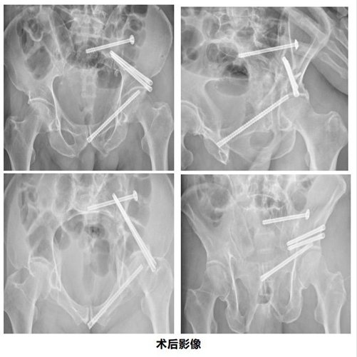 3D printing facilitates minimally invasive treatment of pelvic ...