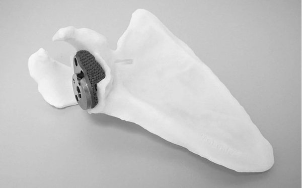 Queensland University of Technology 3D printed insole project helps ...