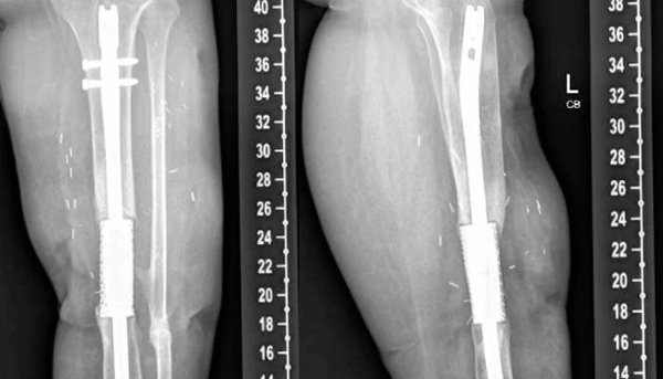 Custom 3D-printed titanium cage successfully treats hard-to-heal bone ...