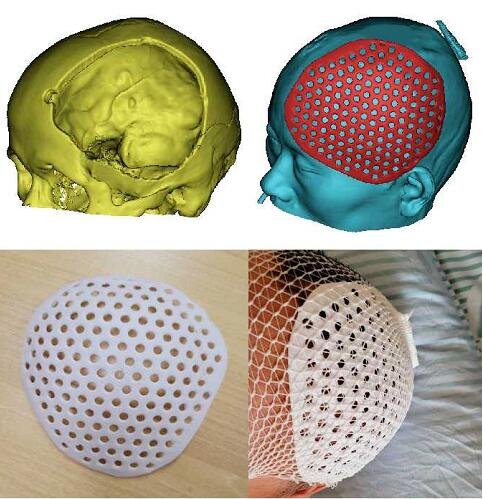 3D-printed 'protective cap' helps repair faulty skulls - GreatLight CNC ...